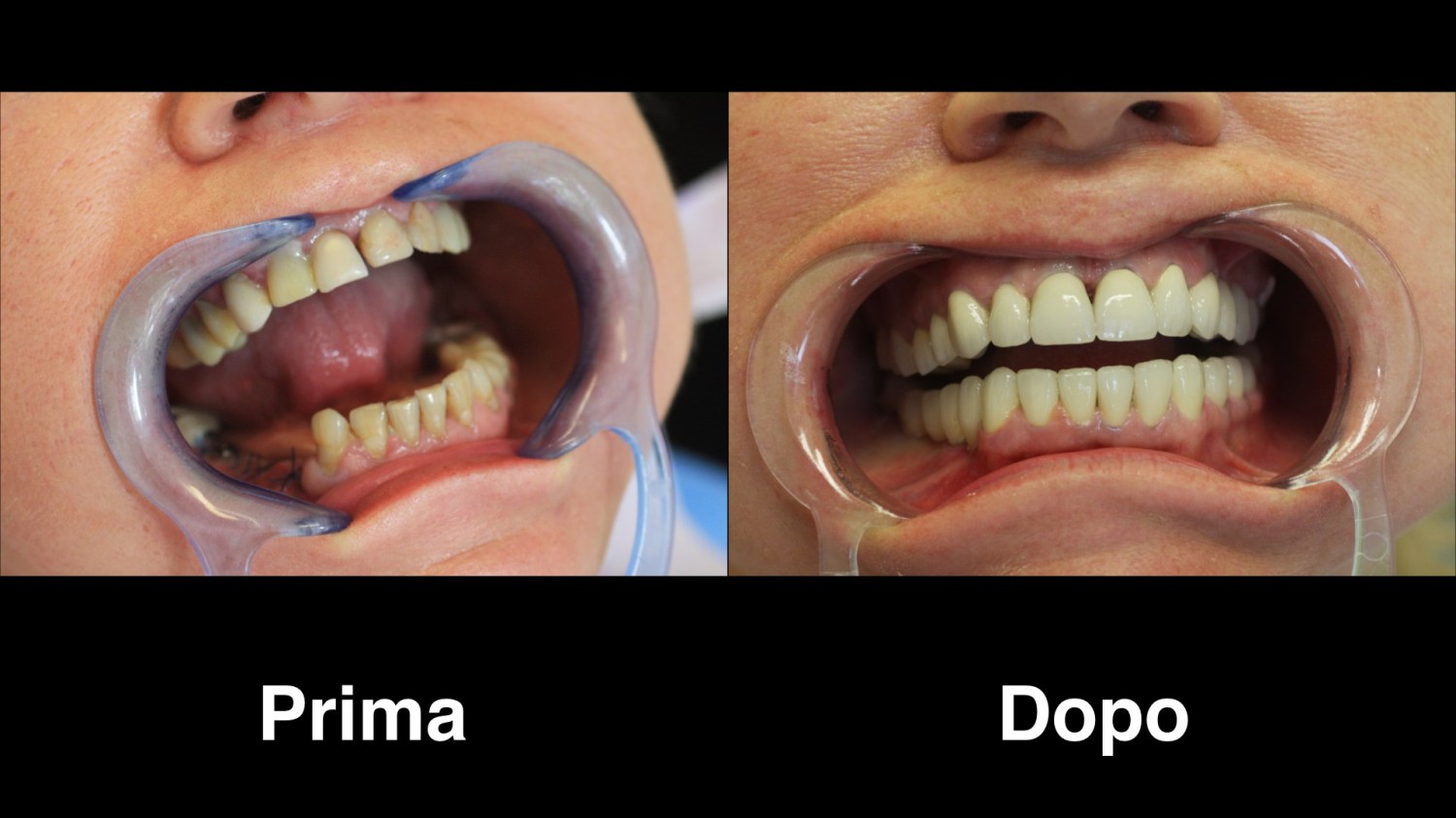 Plastica Gengivale e Ponte su Impianti Dentali - Sos Turismo Dentale